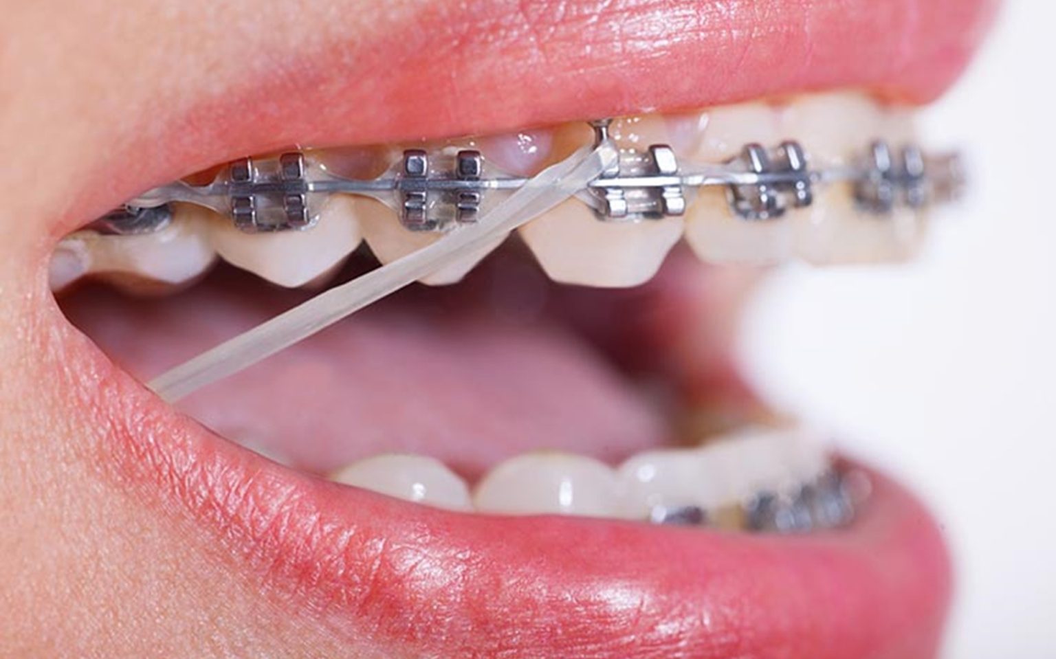 MẤT CHUN LIÊN HÀM CÓ KÉO DÀI THỜI GIAN NIỀNG RĂNG KHÔNG? - Beauty Dental