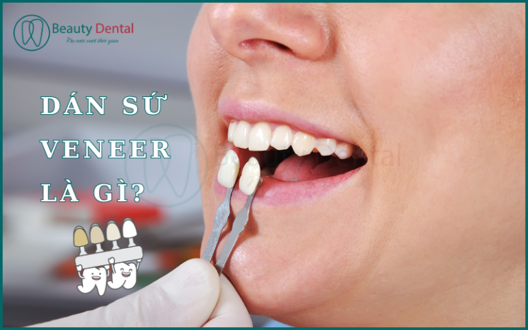 DÁN SỨ VENEER CÓ BỀN KHÔNG? LỜI KHUYÊN TỪ CHUYÊN GIA - Beauty Dental